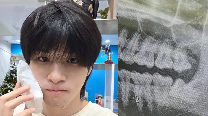 Sky Wongravee Undergoes Wisdom Tooth Surgery After Years of Abnormal ...